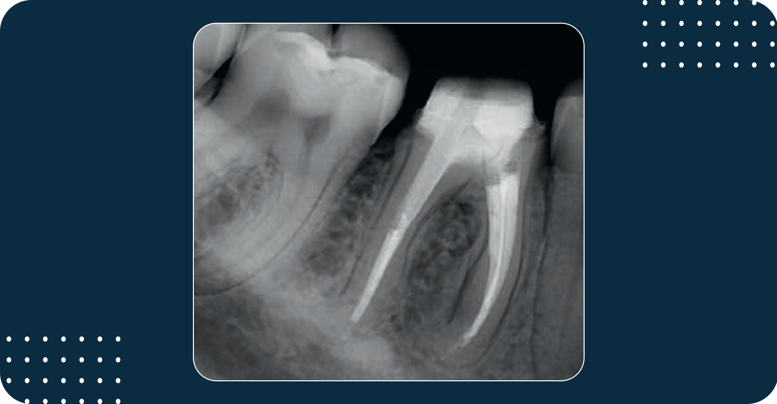 Clinical case on using BioRoot® RCS for root canal filling